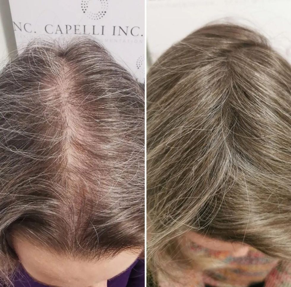 Types of Treatment | Scalp Micropigmentation Liverpool | SMP